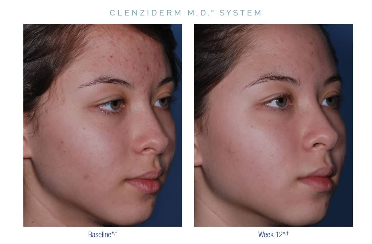 Acne / spots - Dr Kara Cosmetic Clinic