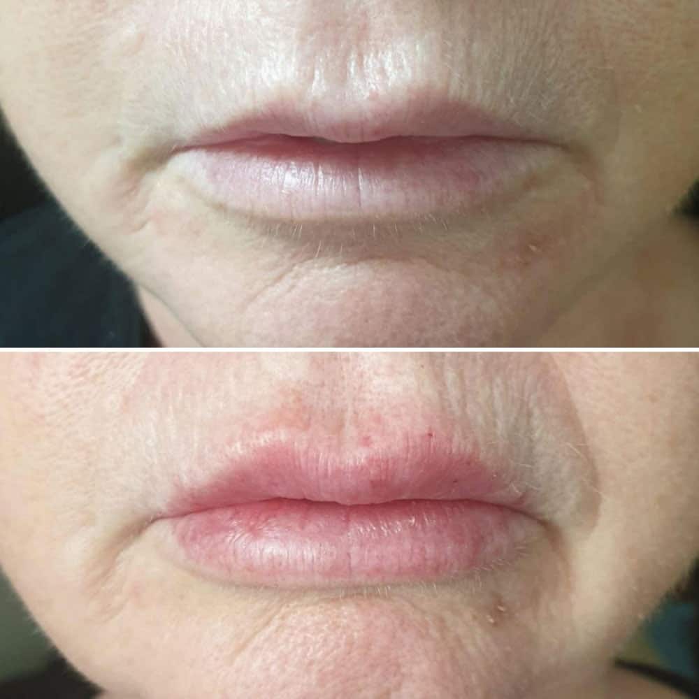 Facial contouring - Dr Kara
