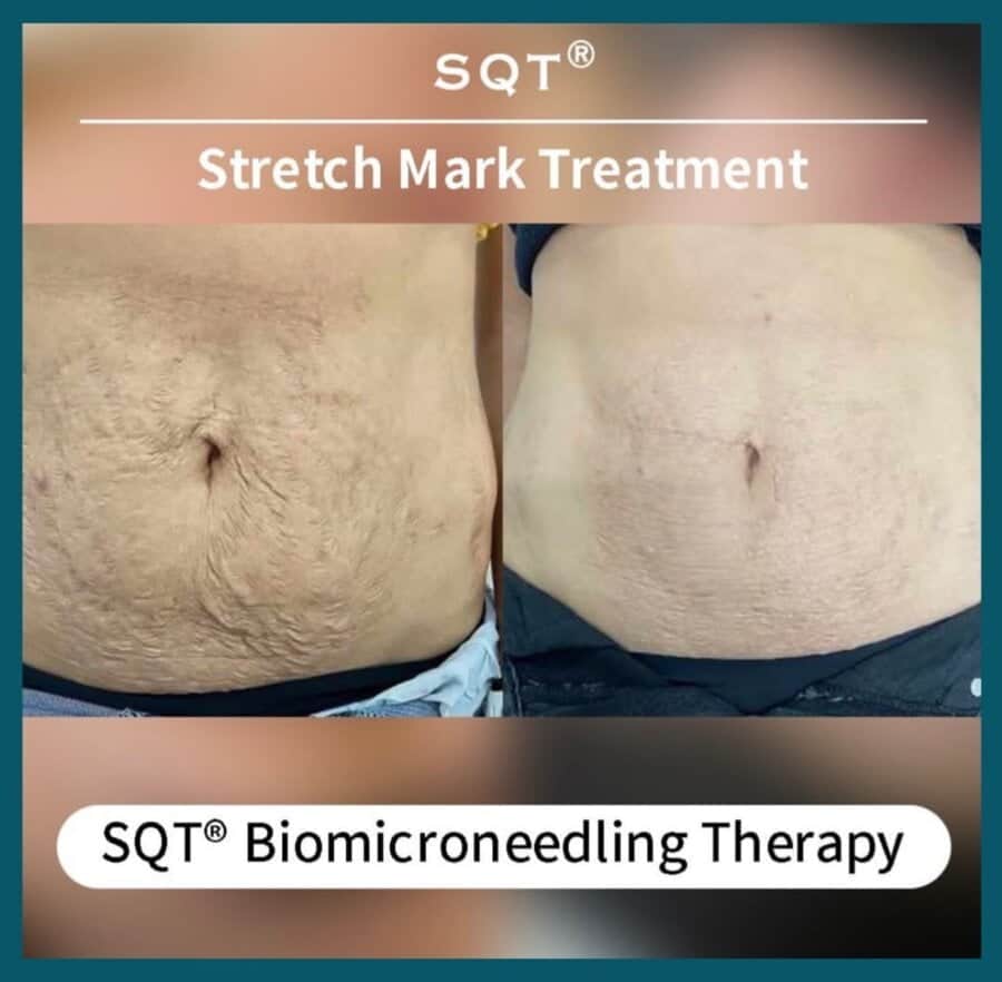 SQT Bio Microneedling - Dr Kara Cosmetic Clinic