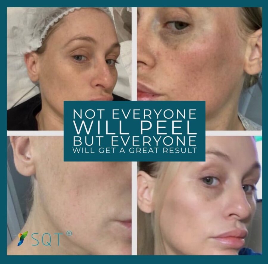 SQT Bio Microneedling - Dr Kara Cosmetic Clinic